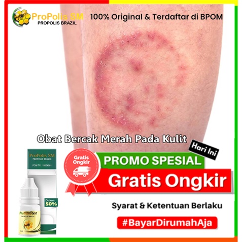 Jual Obat bercak merah pada kulit - Herbal Penghilang Gatal - Gatel ...