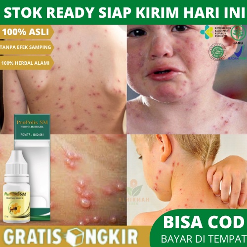 Jual Obat Campak Ruam Merah, Obat Campak Rubella, Obat Kulit Bintik ...