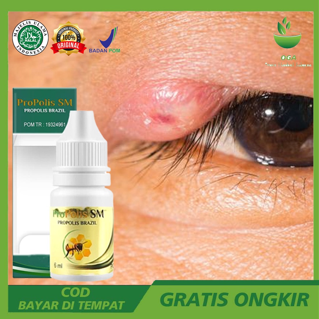 Jual Obat Penghilang Benjolan Kalazion, Benjolan Kalazion di Kelopak ...