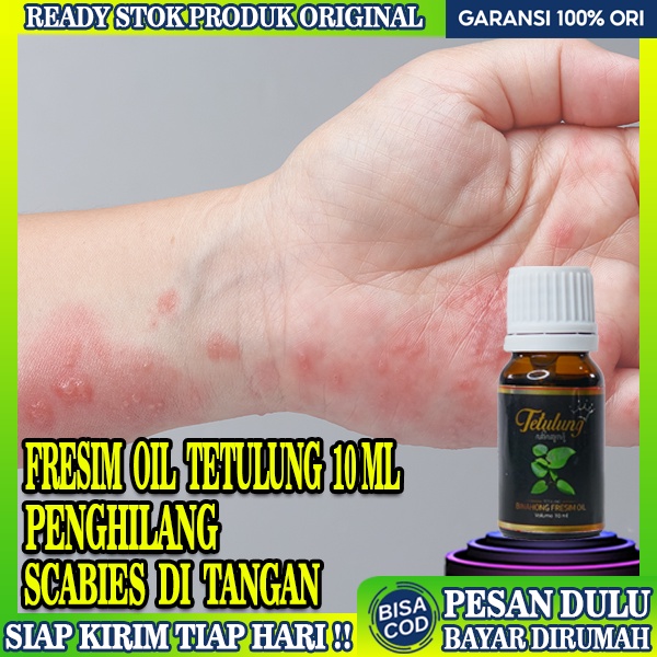Jual Obat Scabies,Obat Budug Seluruh Badan Gatal,Obat Gatal Berair Di ... Jual Obat Scabies,Obat Budug Seluruh Badan Gatal,Obat Gatal Berair Di ...