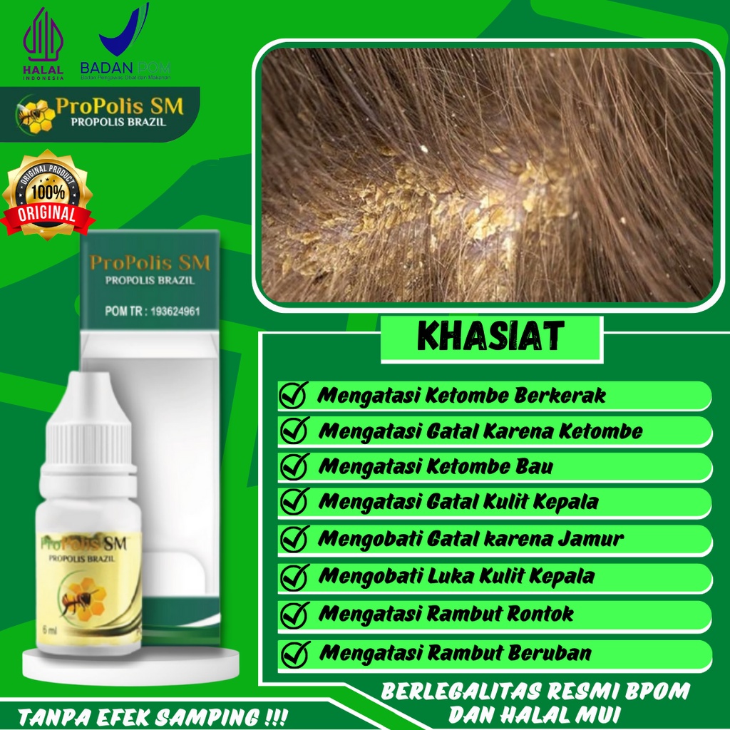 Jual Obat Ketombe Berkerak Ketombe Parah Ketombe Kerak Kulit Kepala Ketombe Membandel Jamur ...
