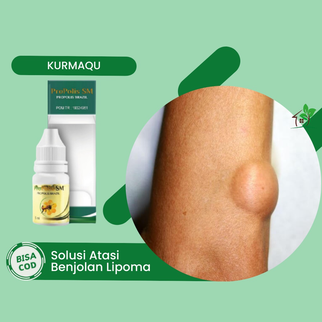 Jual Obat Benjolan Lipoma, Obat Penghancur Benjolan Lipoma, Benjolan di ...