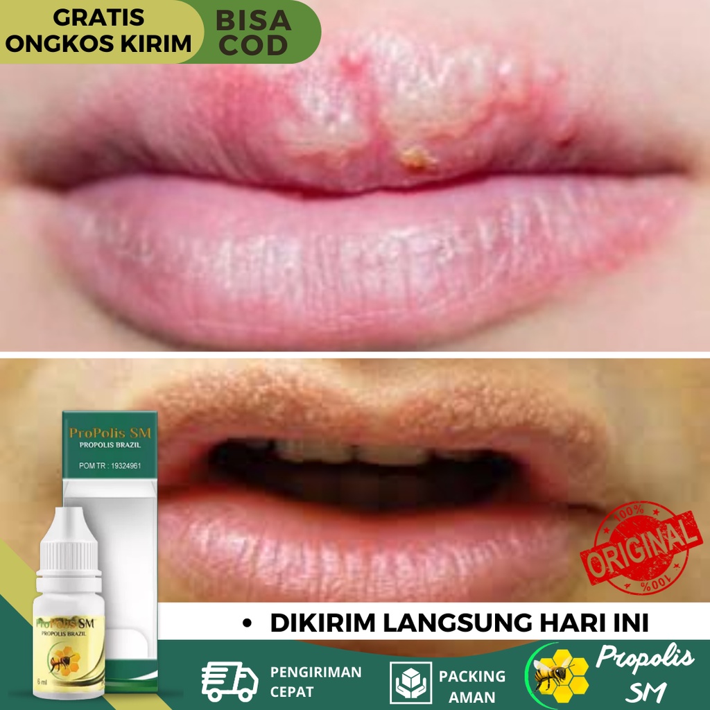 Jual Obat Bintik Putih Di Bibir, Obat Bibir Bintik Berair, Obat Luka ...