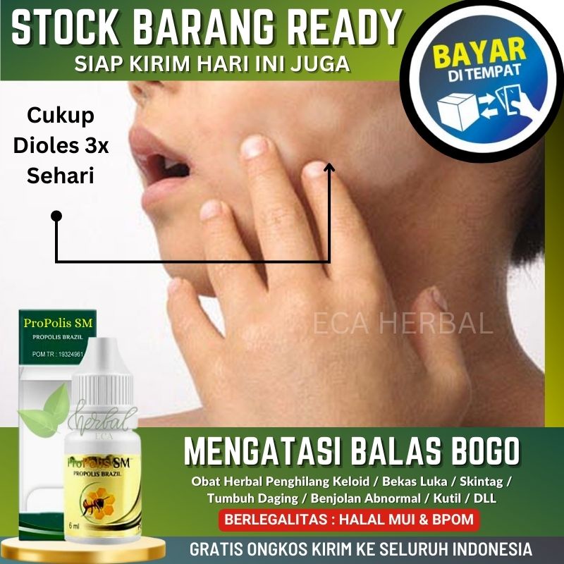 Jual Obat Tetes Penghilang Panu di Wajah / Leher / Punggung / Sekujur ...