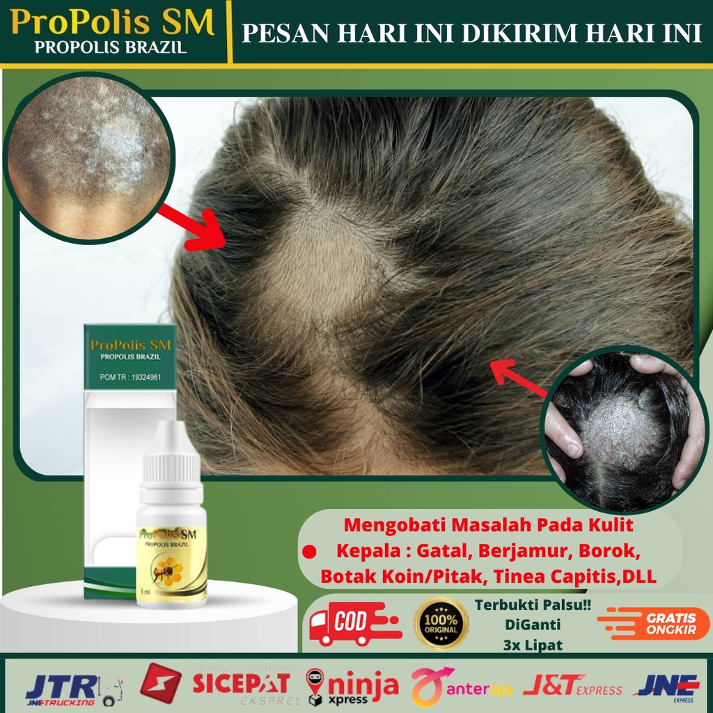 Jual Obat Oles Jamur Di Kulit Kepala, Kepala Berjamur, Gatal, Kulit Autoimun, Obat Botak Koin ...