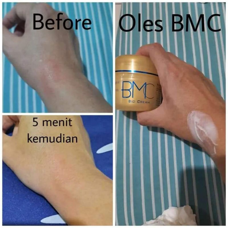 Jual BMC Magic Cream Luka Bakar | Shopee Indonesia