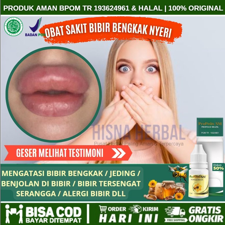 Jual Obat Bibir Bengkak Untuk Anak dan Dewasa, Sakit Bibir Jeding ...