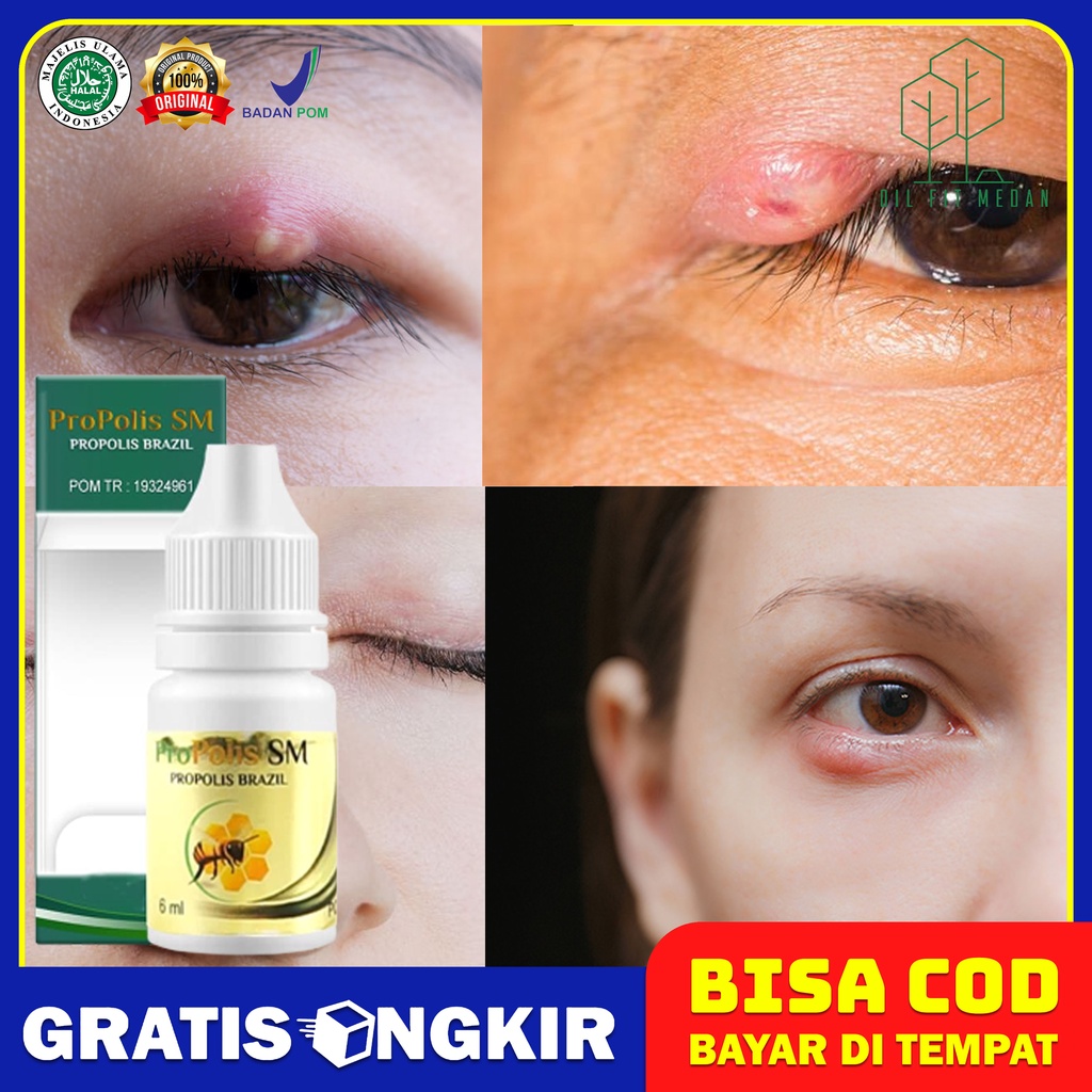 Jual Obat Penghilang Benjolan Kalazion, Benjolan Kalazion di Kelopak ...