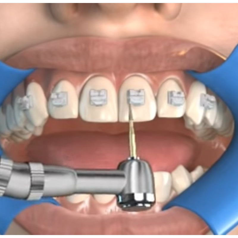 Jual Dental Ortho Debonding Bur Remover Bonding Cement Bracket Behel ...