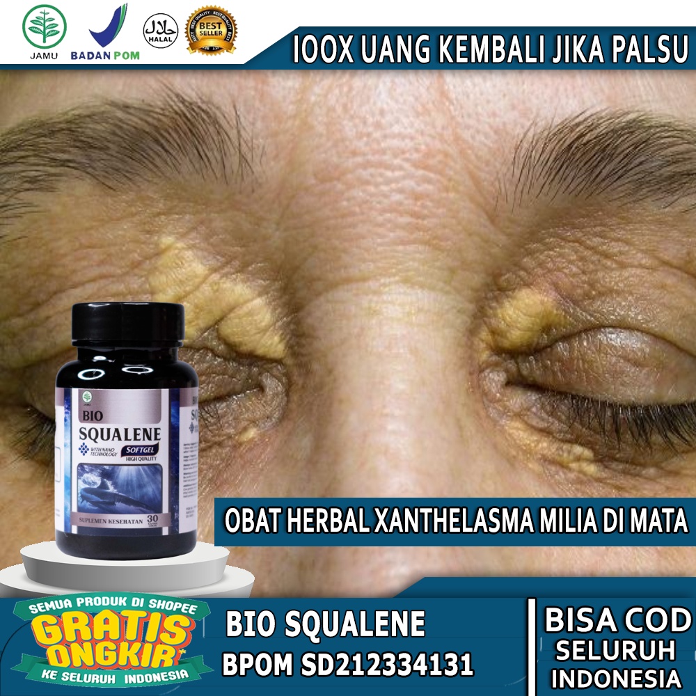 Jual Obat Xanthelasma, Gumpalan Lemak Di Kelopak Mata, Obat Penghilang ...