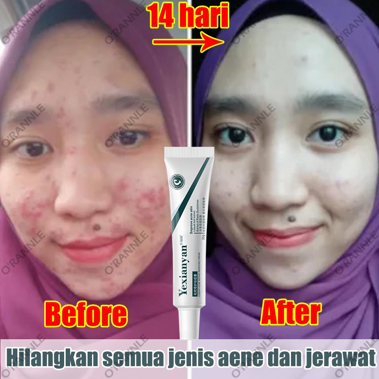Jual 【ORANNLE】[100% Asli] Cream jerawat obat totol jerawat krim jerawat obat jerawat dan bekas ...