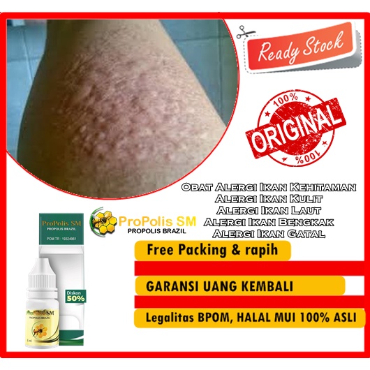 Jual Propolis SM - Obat Alergi Ikan Kehitaman, Obat Alergi Ikan Kulit ... Jual Propolis SM - Obat Alergi Ikan Kehitaman, Obat Alergi Ikan Kulit ...