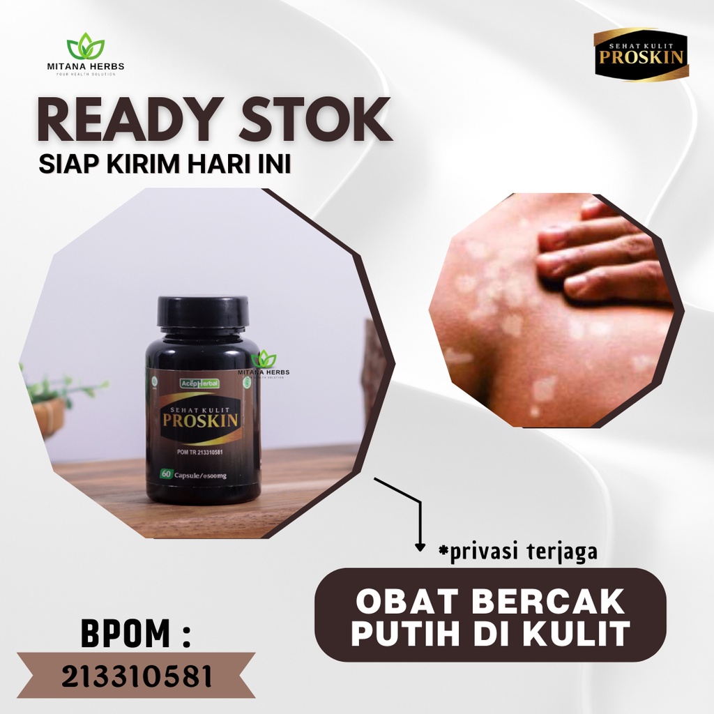Jual Mitana Herbal - Obat Bercak Putih Pada Kulit - Obat Bercak Putih ...