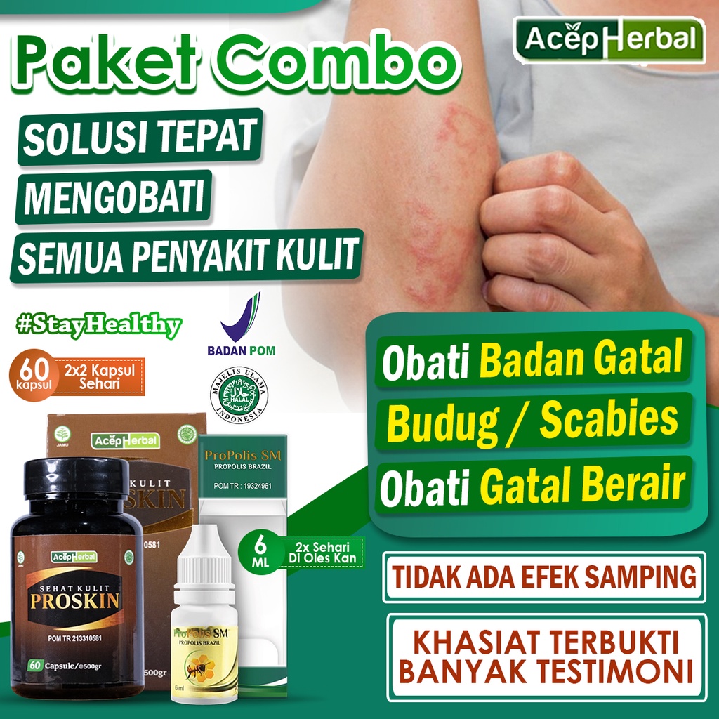 Jual Obat Badan Gatal Buduk Kulit Gatel Berair di Jari Tangan dan Kaki Ruam Kulit Bercak Bintik ...