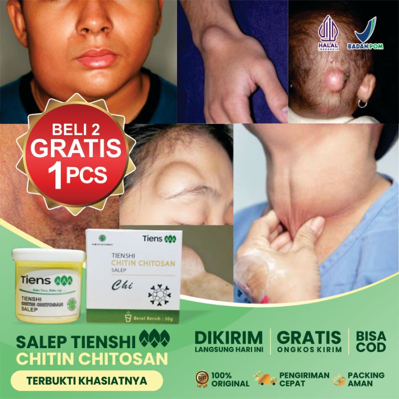 Jual SALEP BENJOLAN (BISUL)(LIPOMA) BENJOLAN DI TANGAN, BENJOLAN DI ...
