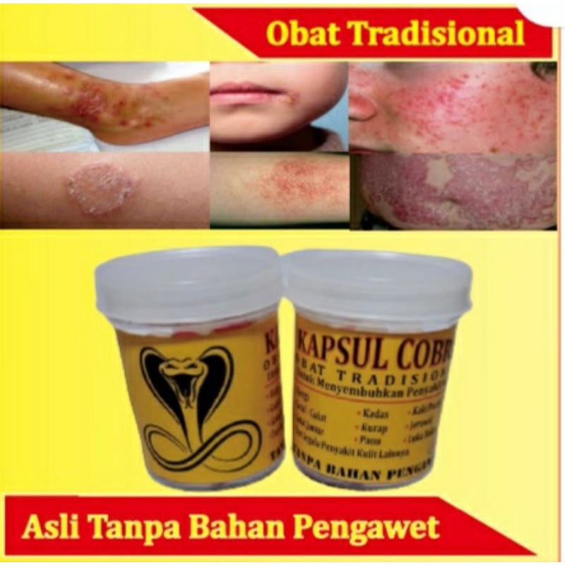 Jual Kapsul Ular Cobra 10 Kapsul/Obat Gatal/Obat Eksim/Obat Jerawat/Obat Alergi Dan Penyakit ...