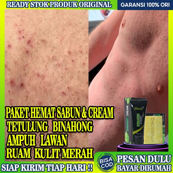 Jual Obat Ruam Merah Pada Kulit,Obat Ruam Merah, Paket Hemat Cream ...
