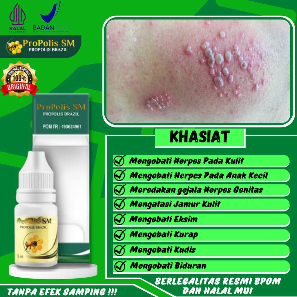 Jual Obat Herpes Kulit Herpes Genitas Herpes Zoster Herpes Kelamin ...