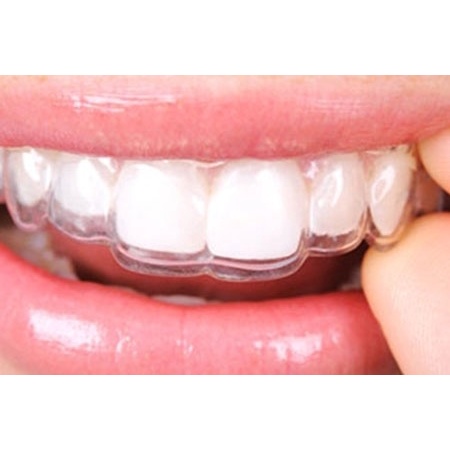 Jual RETAINER GIGI TRANSPARAN / CLEAR RETAINER / ESSIX RETAINER ...