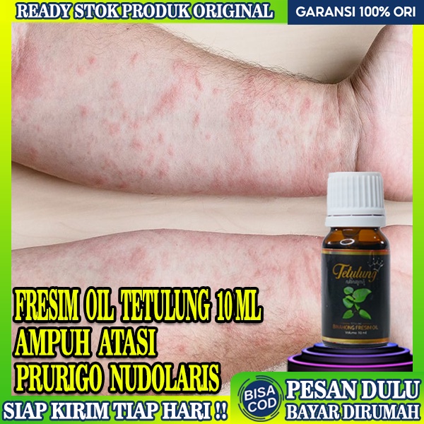 Jual Obat Prurigo,Obat Darah Manis Prurigo,Obat Prurigo Nudolaris,Obat ...