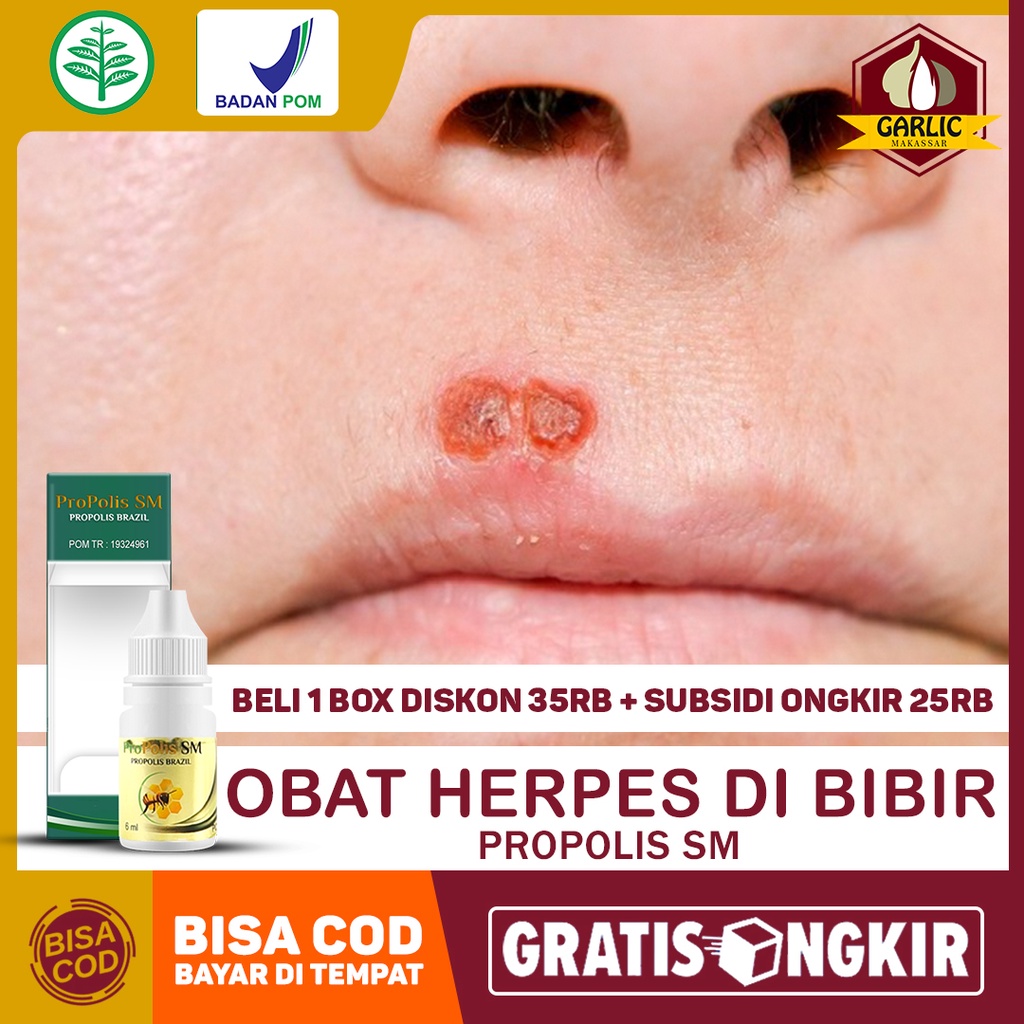 Jual Obat Herpes Di Bibir, Luka Melepuh Sekitar Bibir, Bintik Putih Di ...