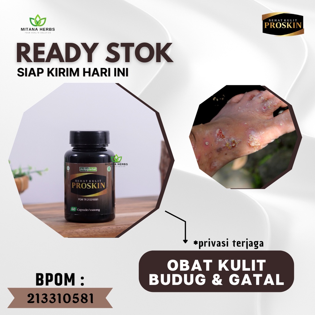 Jual Mitana Herbal - Obat Budug Bernanah - Obat Budug Kulit Gatal ...