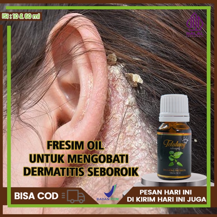 Jual Obat Dermatitis Seboroik, Obat Oles Penyakit Dermatitis Seboroik ...