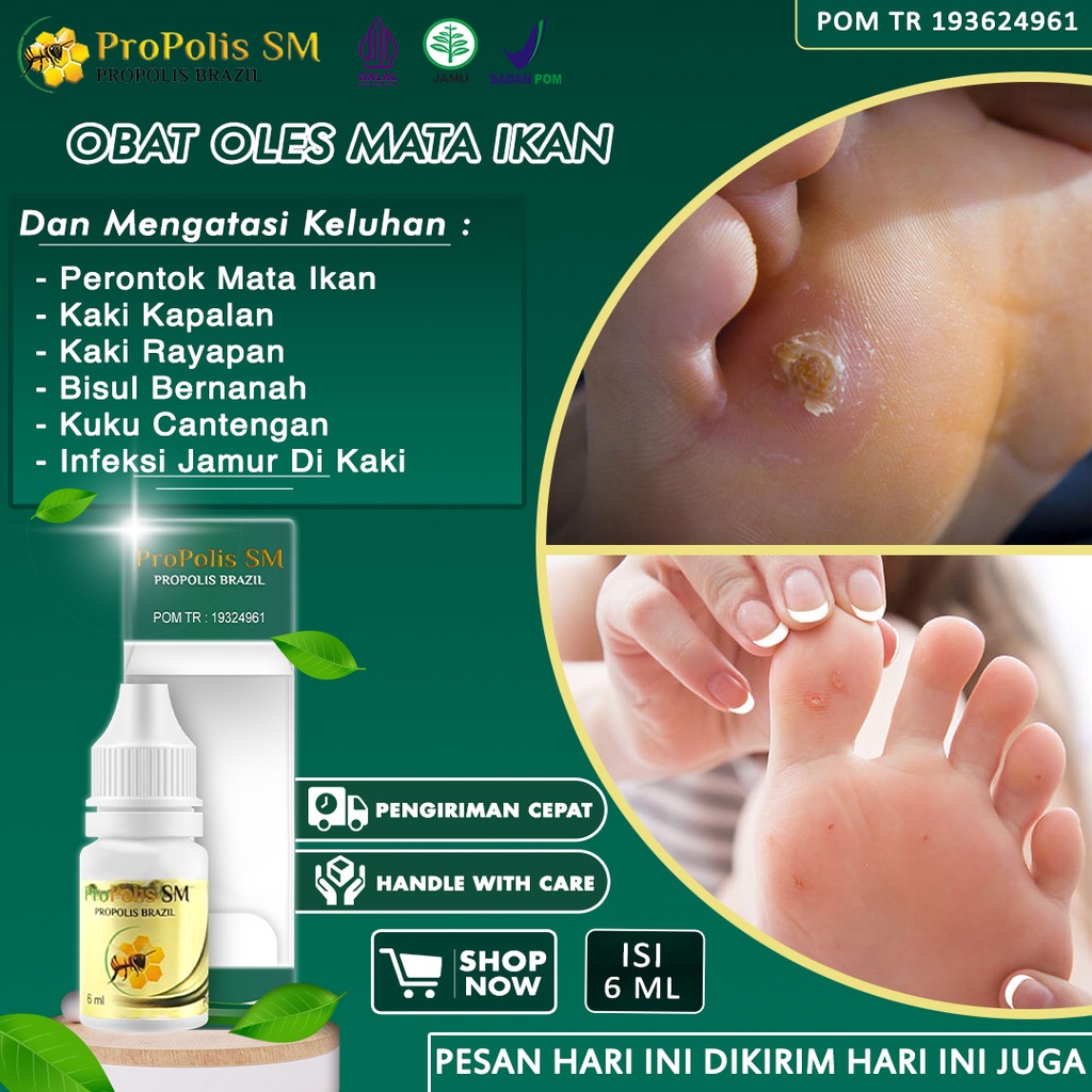 Jual Obat Oles Mata Ikan Salep Cair Perontok Mata Ikan Kaki Kapalan ...