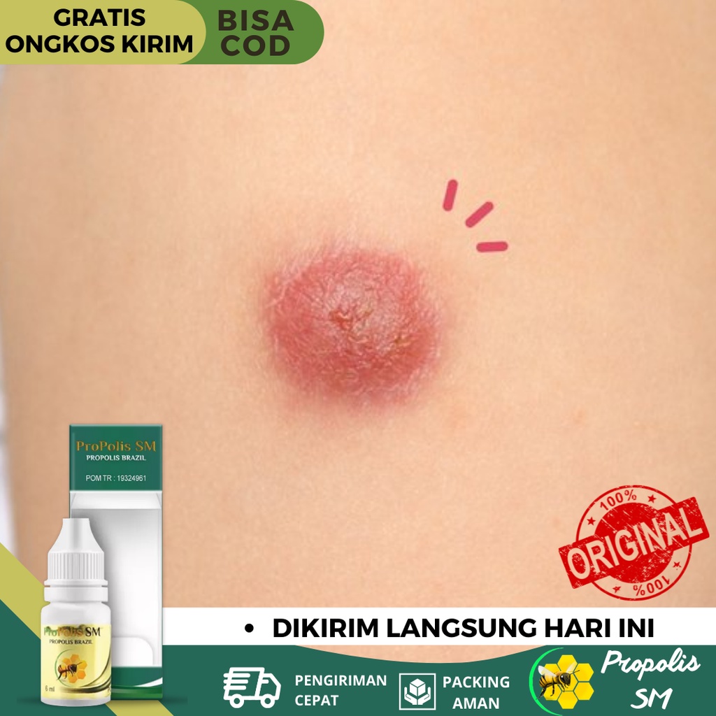 Jual Obat Bisul, Obat Bisulan Di Tubuh, Obat Bisul Bernanah, Obat Bisul Telur Kodok, Obat ...