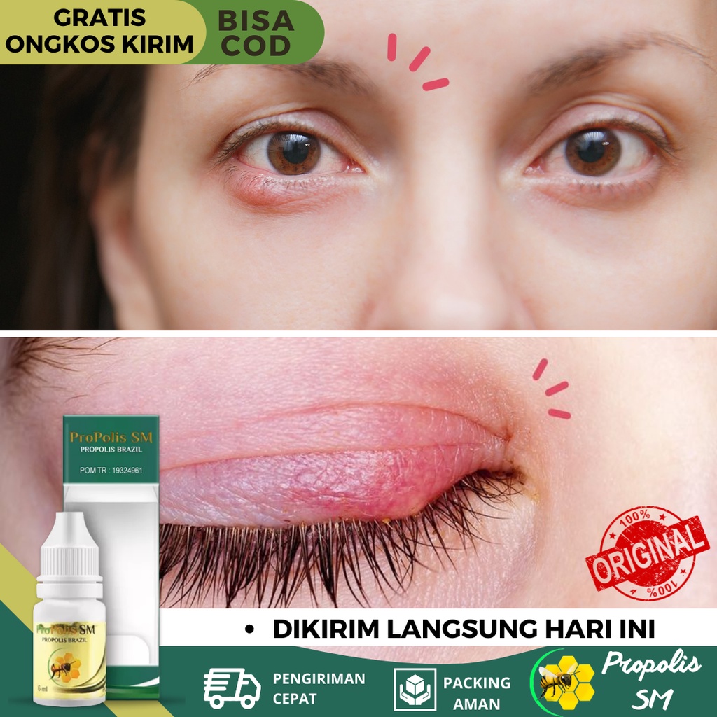 Jual Obat Mata Kalazion, Obat Kelopak Mata Bengkak, Obat Mata Bintitan ...