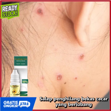 Jual salep penghilang bekas cacar yang berlubang, penghilang bekas ...