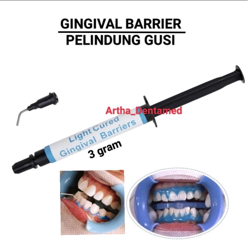 Jual GINGIVAL BARRIER / GINGIVA PROTECTOR / GUM PROTECTOR / PELINDUNG ...