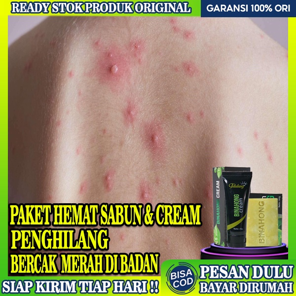 Jual Obat Bercak Merah Paket Hemat Sabun Binahong 100g dan Cream ...