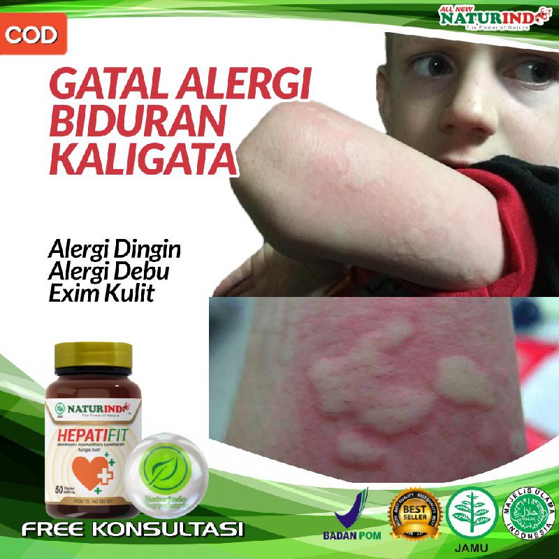 Jual Obat Gatal Kulit Obat Biduran Ampuh Obat Kaligata Herbal Obat Exim ...