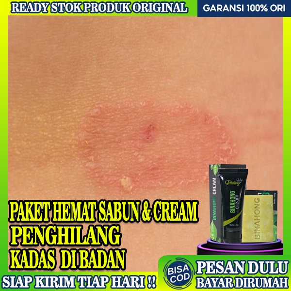 Jual Paket Hemat Sabun Dan Cream Binahong 20g,Obat Penghilang Kadas ...