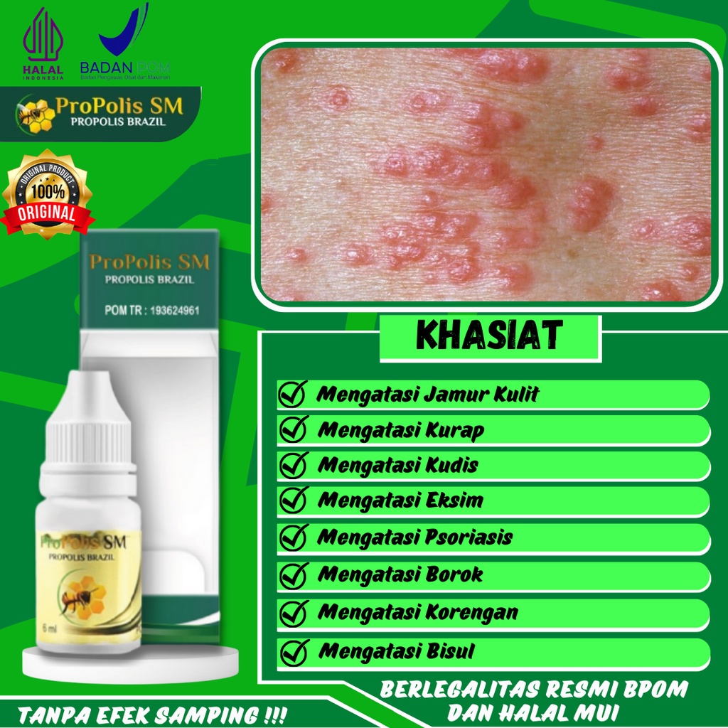 Jual Obat Gatal eksim Dan Jamur Kulit Obat Kudis Obat Kurap Obat Eksim ...