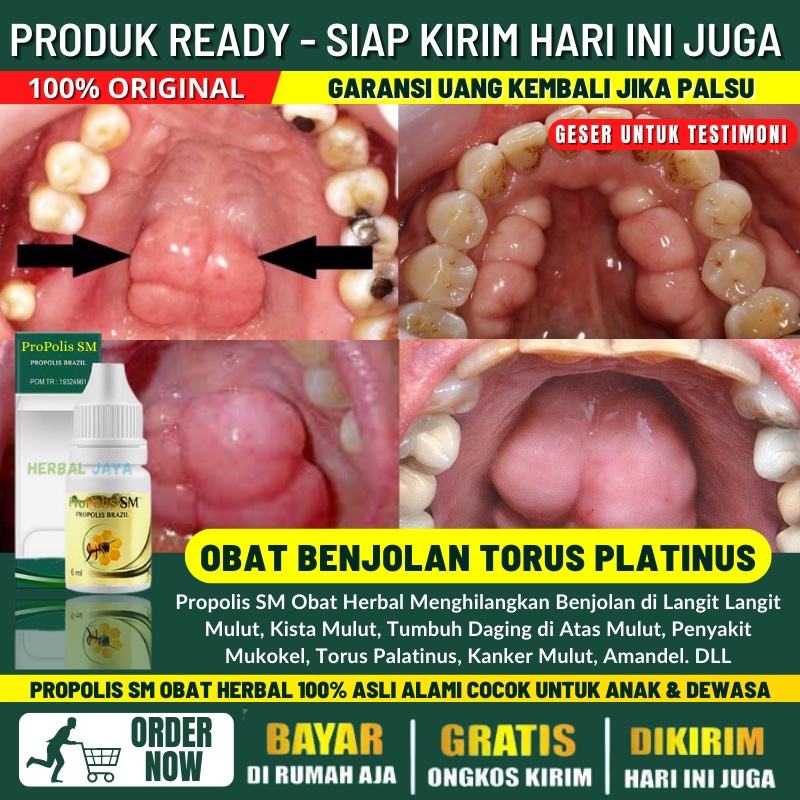 Jual Obat Torus Palatinus Untuk Anak & Dewasa 100% Alami, Benjolan Kecil / Besar di Langit ...