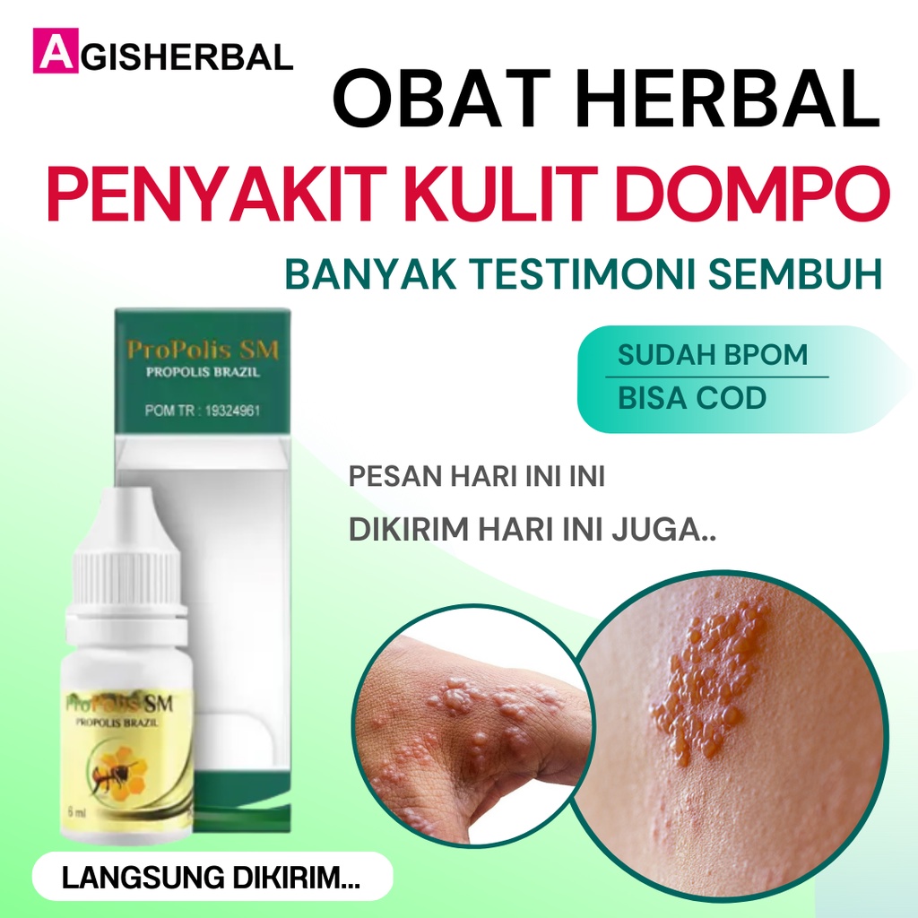 Jual Obat Dompo Penyakit Kulit Herpes Zoster Propolis Sm Brazilian 100% ...