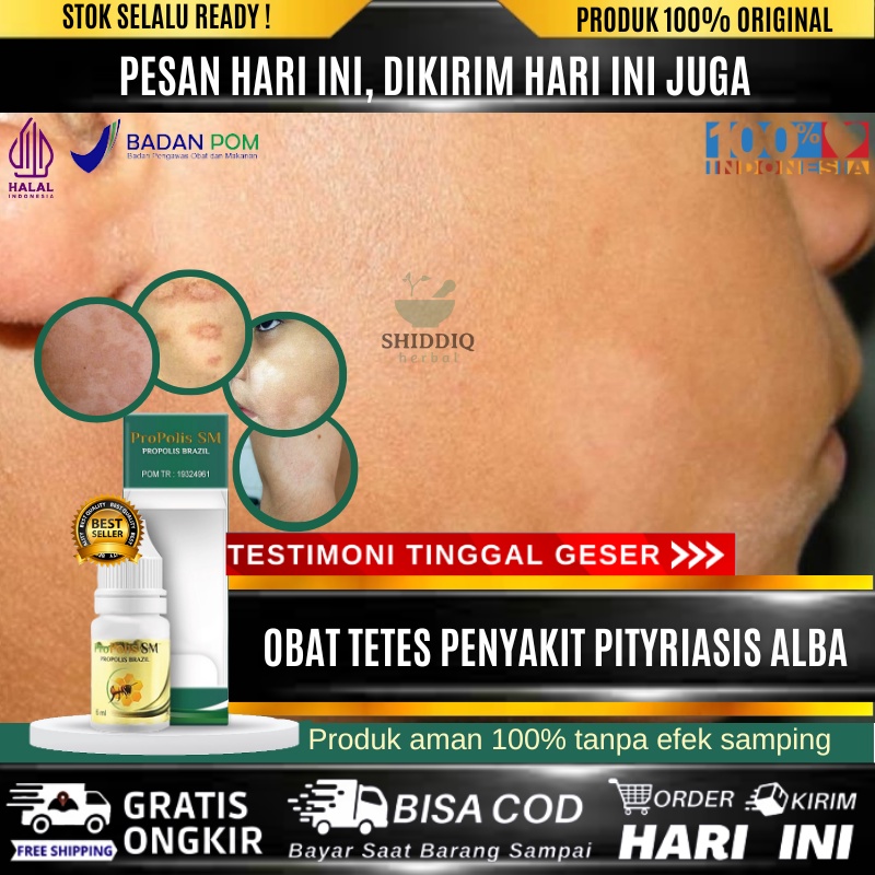 Jual Obat Pityriasis Alba Untuk Anak dan Dewasa, Penghilang Bercak ...