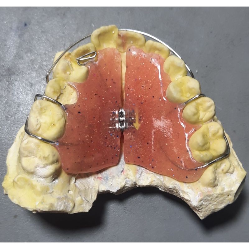 Jual removeable ortho ( behel lepasan ) untuk merapikan gigi yang tidak ...