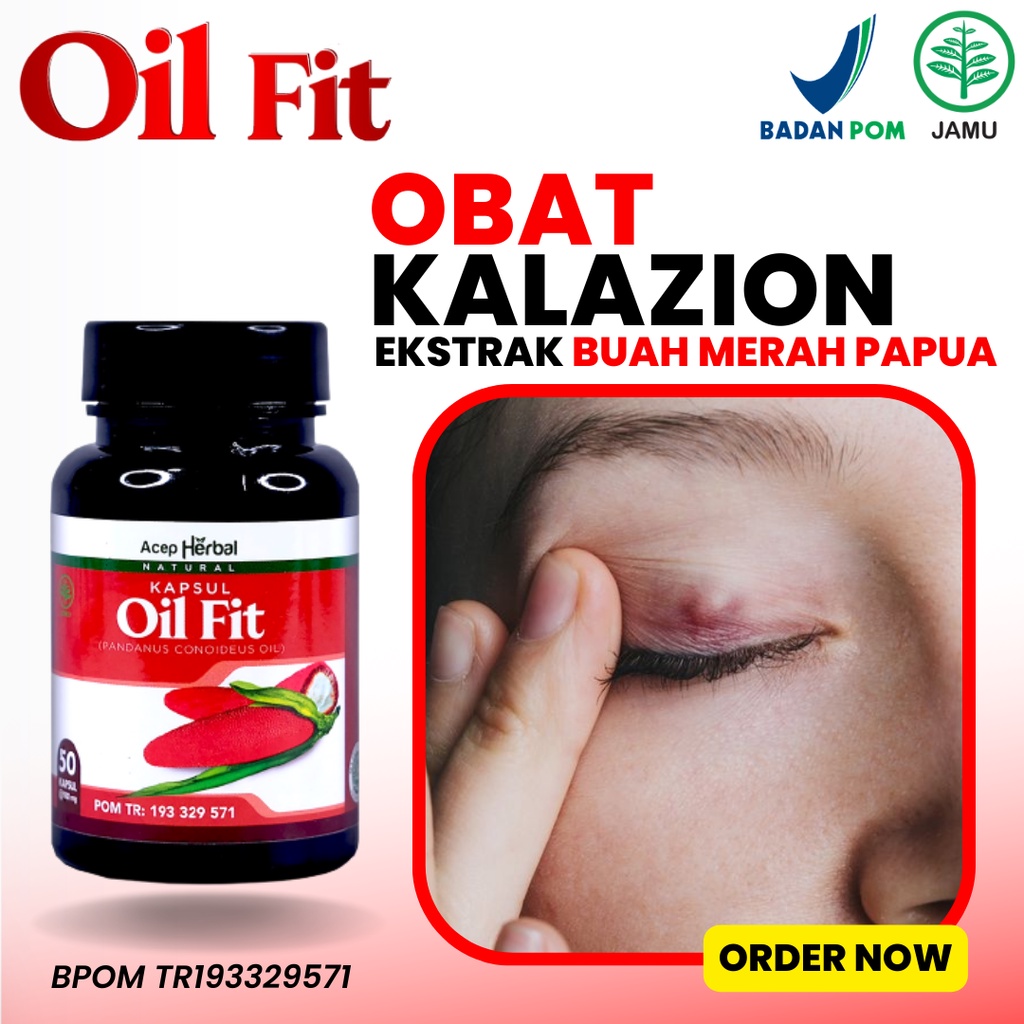 Jual Obat Kalazion Mata Penghilang Benjolan di Kelopak Mata Pengempis ...