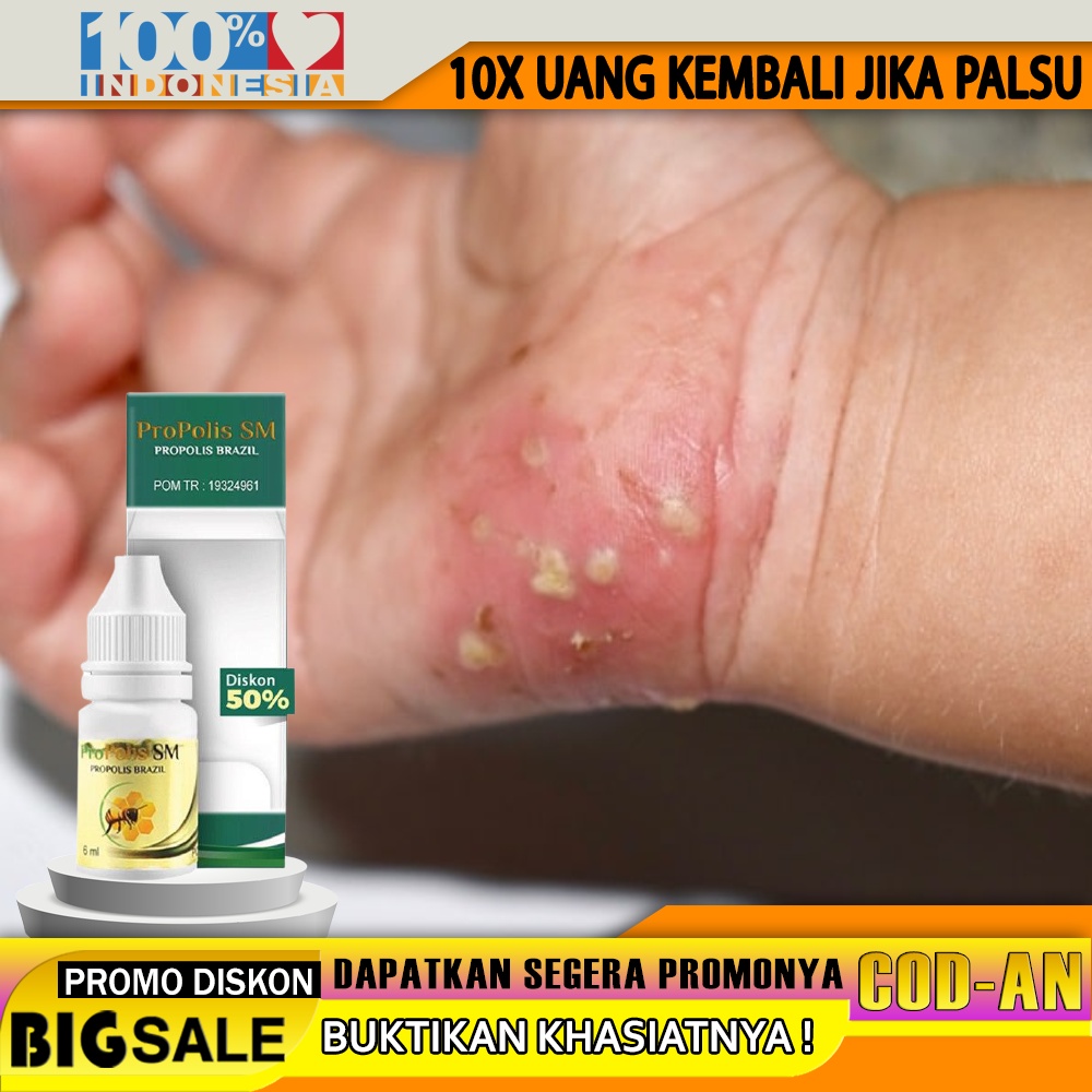 Jual Obat Cenang Bernanah ana, Cenang Di Tangan, Cenang Di Telapak ...
