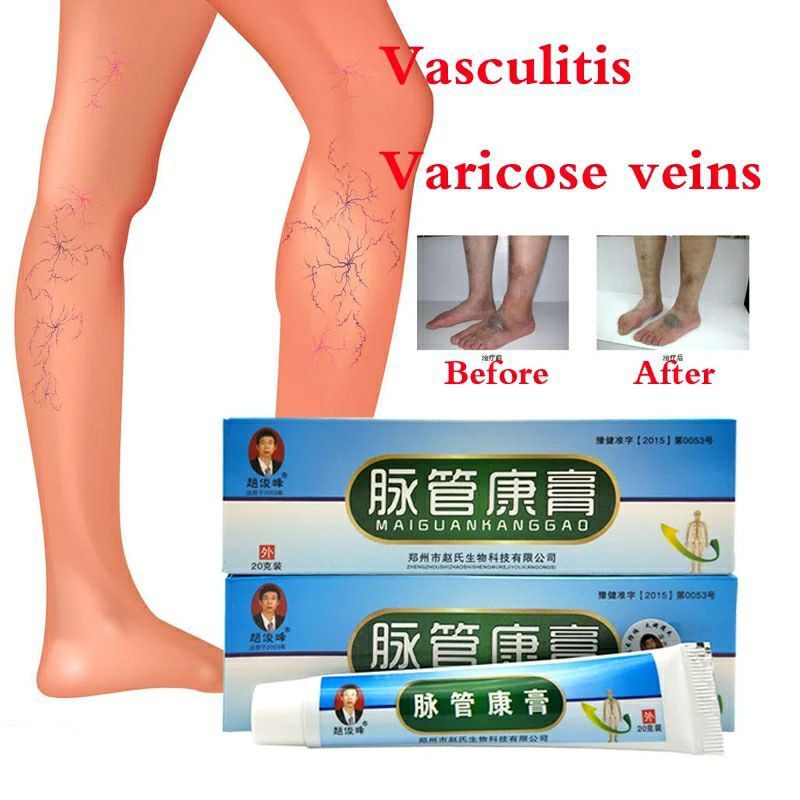 Jual TRIPLE A - Obat Varikokel Salep Varises Cream Varicose Veins Obat ...
