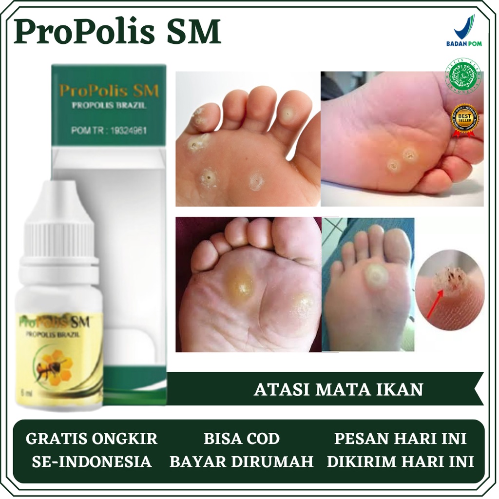 Jual Obat Mata Ikan, Obat Perontok Mata Ikan, Obat Mata Ikan di Telapak ...