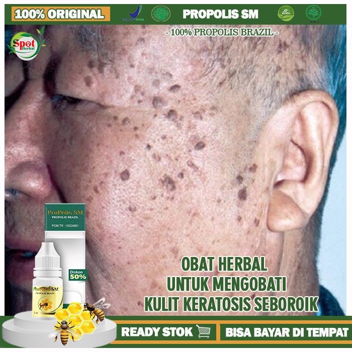 Jual Obat Keratosis Seboroik Di Wajah, Obat Keratos Pilaris, Obat ...
