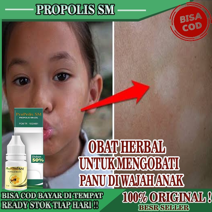 Jual Obat Panu Di Wajah Anak, Obat Panu Anak, Obat Kulit Panuan Pada ...