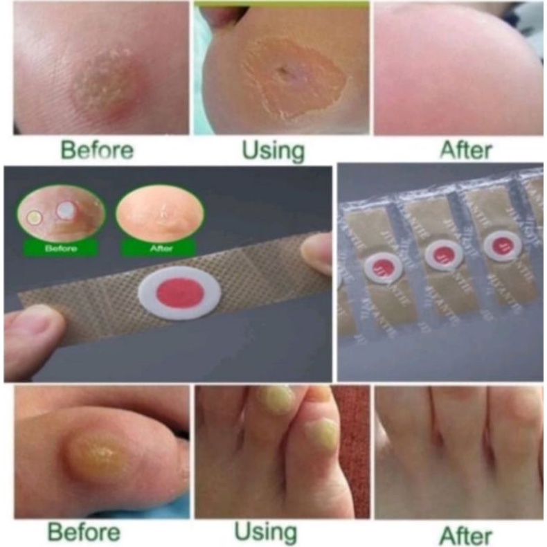 Jual Plaster Kutil Mata ikan tanpa operasi 1 strip 6 Pcs | Shopee Indonesia