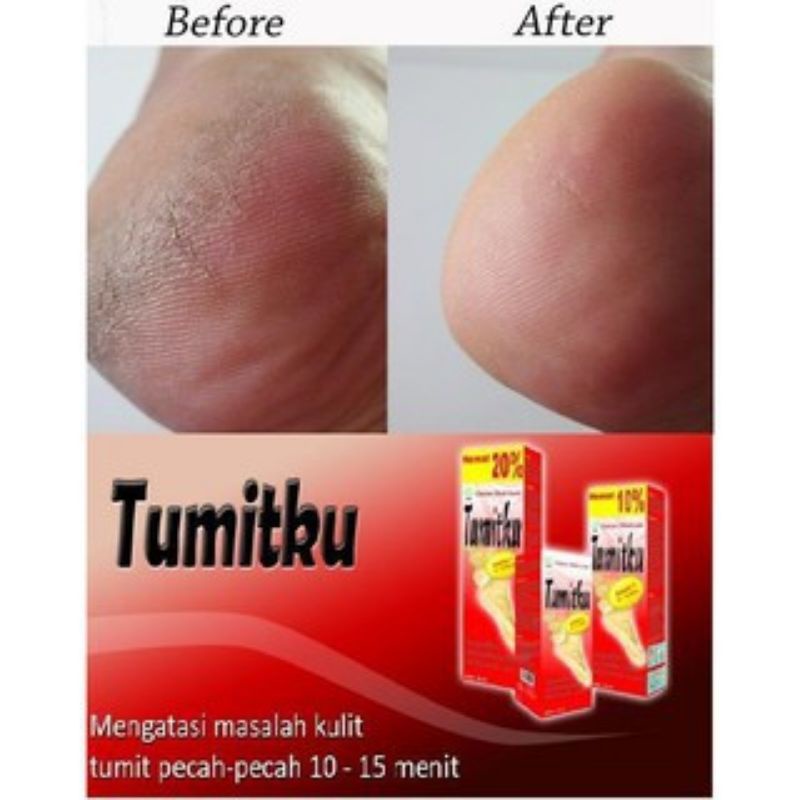 Jual TUMITKU OBAT TUMIT KAKI KAPALAN PECAH KERING KASAR Original BPOM ...