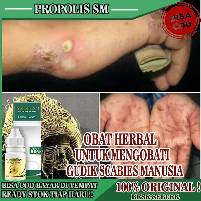 Jual Obat Gudik Scabies Manusia, Obat Budug Bernanah, Obat Gudik Santri ...
