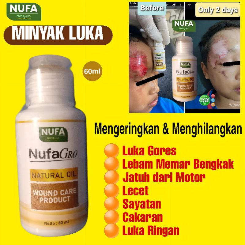 Jual Nufagro Minyak Obat Luka Gores Lebam Memar Dan Bengkak Lecet Jatuh ...